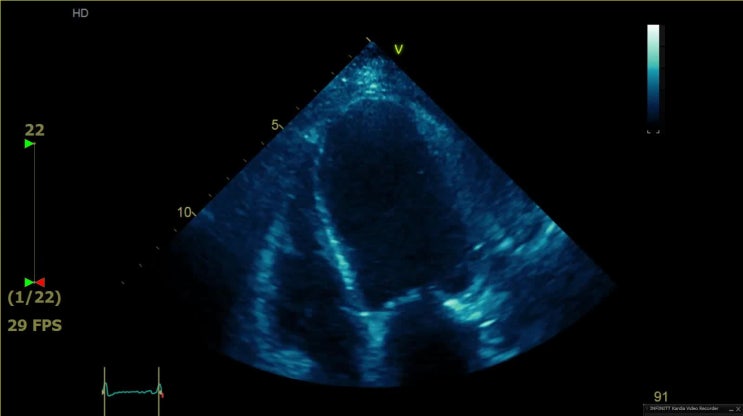 심근경색 (Myocardial infacrtion)LAD MI : 네이버 블로그