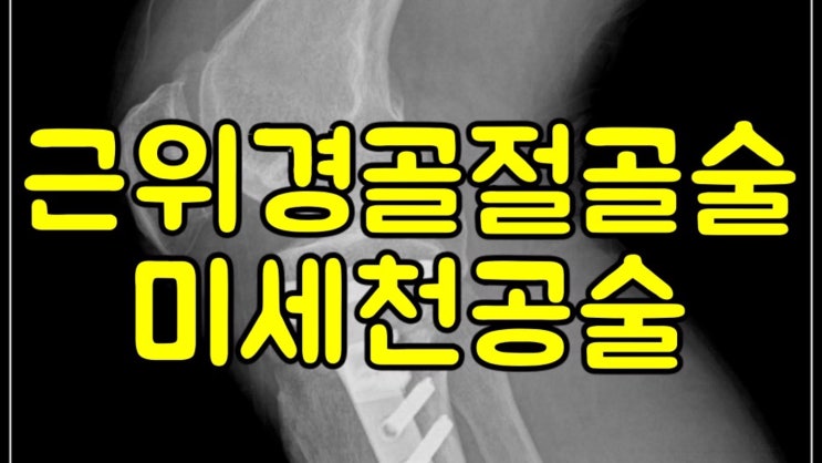 근위경골외반절골술과 함께 시행한 연골재생술 및 연골판절제술 By 정형외과 전문의 권제호 무릎 수술 일지 네이버 블로그
