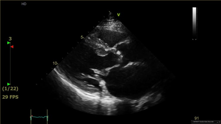 Mitral valve perforation : 네이버 블로그