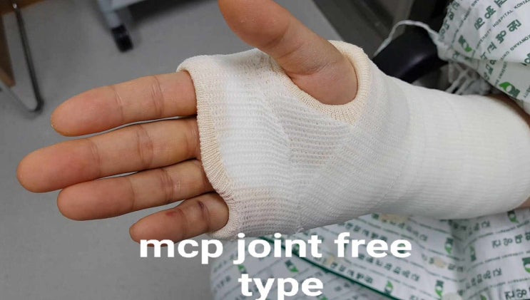 MCP Joint free type / Short arm cast : 네이버 블로그