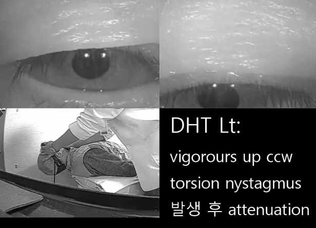 [case review][common BPPV] Posterior Canal cupulolithiasis- Diagnosis ...