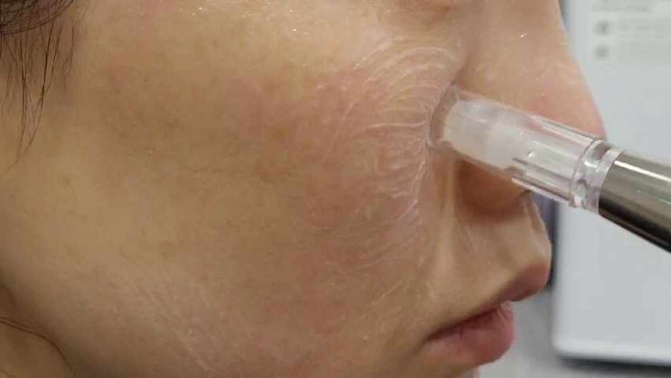 MTS시술 후 관리법 & 부작용 & 주의사항 : 네이버 블로그