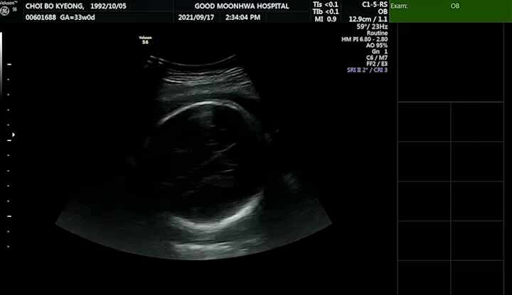 임신중기록 임신 후기 8개월에서 10개월까지 제왕절개 수술날 잡기 후기 입덧 그리고 막달 검사 네이버 블로그