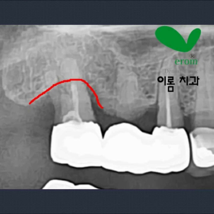 서초역치과 당뇨가 있을 때 상악동 거상술 없이 숏임플란트로 해결 한 케이스 네이버 블로그
