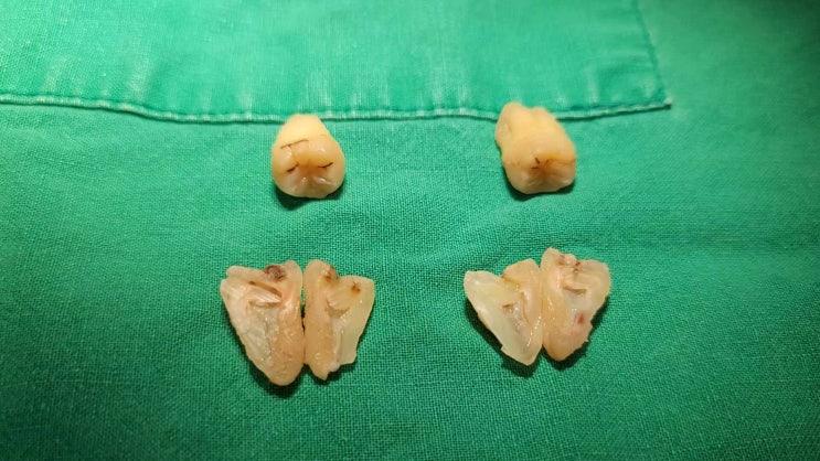 사랑니발치과정과 발치후 후기 수면마취로 보다 편안하게 남양주 구리치과에서 가까운 저희 치과 네이버 블로그