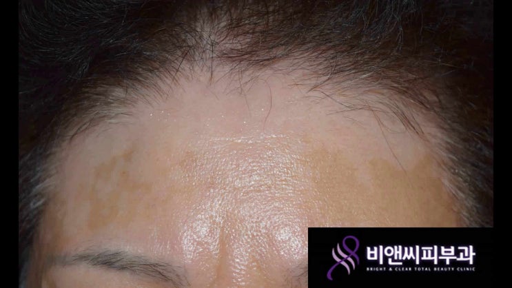 얼굴백반증치료 피부과전문의의 엑시머레이저로 안전하고 효과적인 치료 시작하세요 네이버 블로그