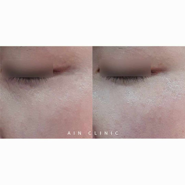 눈 밑 주름 개선한 30대 여성 사례로 보는 아이슈링크 효과 압구정동피부과 네이버 블로그