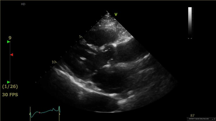 Constrictive pericarditis(교착성 심내막염) : 네이버 블로그