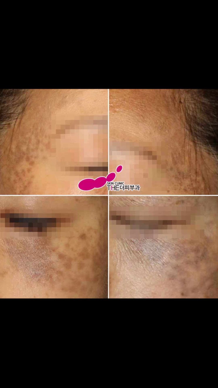 후천성 오타모반은 광대 이마등 얼굴에 대칭적으로 발생합니다 루비레이저와 피코레이저의 장점을 결합한 통증 걱정 없이 오타모반