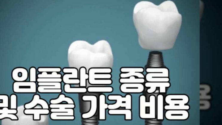 임플란트 종류 및 수술 가격 비용 비교 싼 곳 Best 11 앞니 어금니 뼈이식 목동 추천 치과 구미 수원