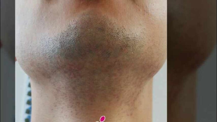 우수한 제모효과와 Dcd 냉각시스템 탑재로 통증 줄인 젠틀맥스제모 남자수염 제모는 인천 구월동에서 가까운 The에서 젠틀맥스프로 레이저를 찾을 수 밖에 없어요 네이버 블로그