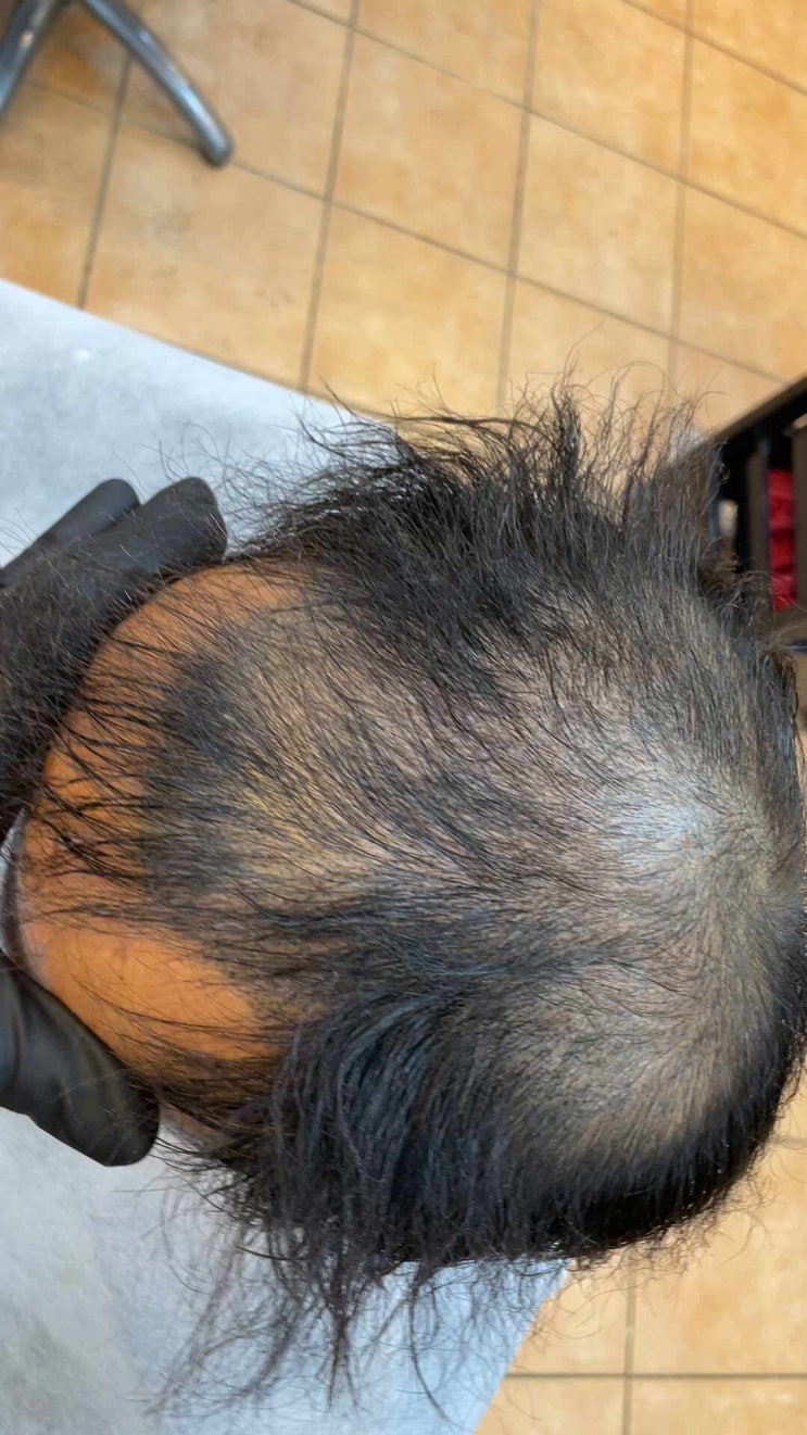 심한남자탈모 탈모펌헤어해독염색miracle 사상주례경남거제김해경북전라전북대구밀양구미양산녹산울산진주사천하동대저화명경주대동명지수영