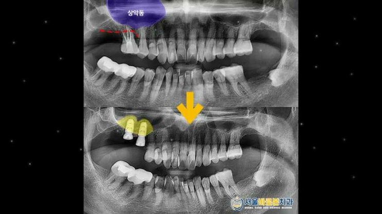 은행동임플란트치과 상악동거상술과 동시에 임플란트를 네이버 블로그