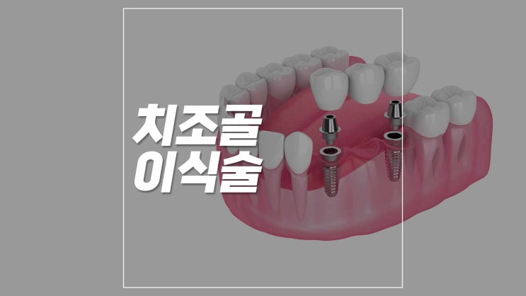 ‘성남 시흥동 임플란트 올바른 임플란트를 위한 치조골 이식술 네이버 블로그
