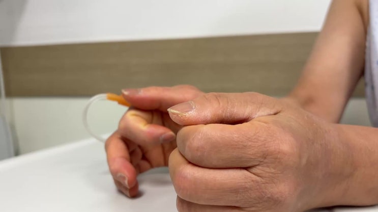 엄지손가락이 안올라가요. 요골 원위부 골절 ; Delayed EPL rupture - EIP transfer, wrist ...