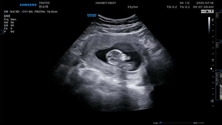 12w3d 포도♡1차기형아 검사 받는날♡ : 네이버 블로그