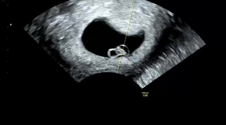 [임신 6w5d] 임신 6주5일차 첫 심장소리, 산후조리원 예약 (+해안칼국수 맛집)ㅣ아인병원(아인비) : 네이버 블로그