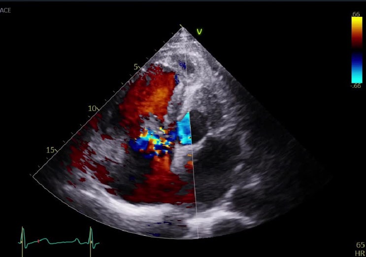 VSD Gerbode type shunt : 네이버 블로그