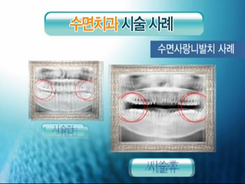 금&레진 인레이와 세렉보철의 차이점은?? 보철치료 후 관리는 어떻게 하나요? [세렉보철/보철치료] : 네이버 블로그