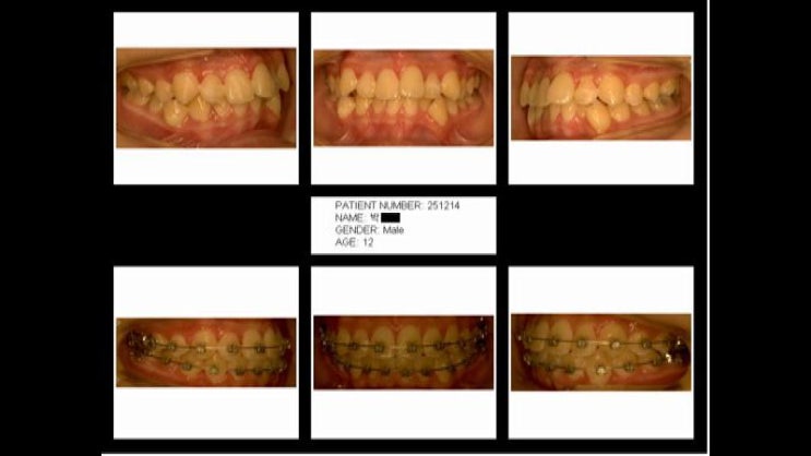 클리피씨(Clippy-C)를 이용한 자가결찰 치아교정 : 네이버 블로그
