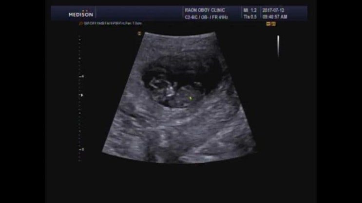 9w-12w3d) 힘든 입덧, 정신없는 임신초기 : 네이버 블로그