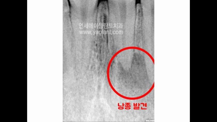 치근단절제술로 치아뿌리염증치료 한방에 잠실역신림역남태령역이수역동작역논현역신사역청담역 유명한치과 네이버 블로그