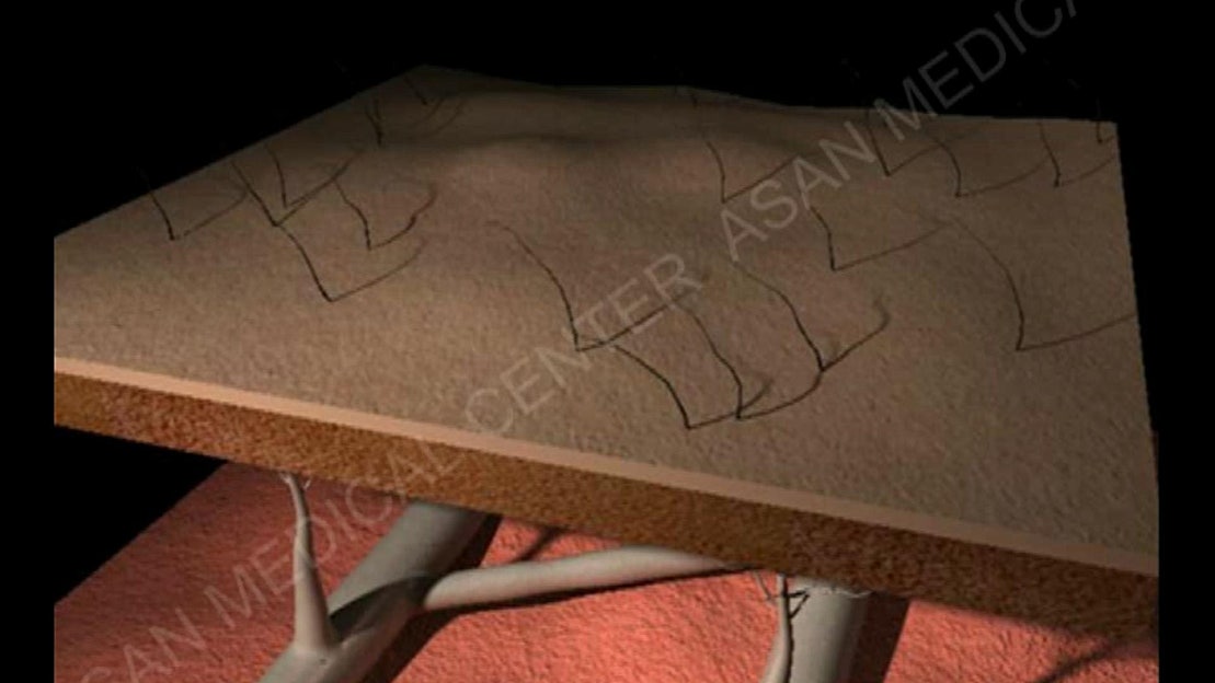 림프 부종의 원인 (Causes of Lymphedema) - 네이버 TV