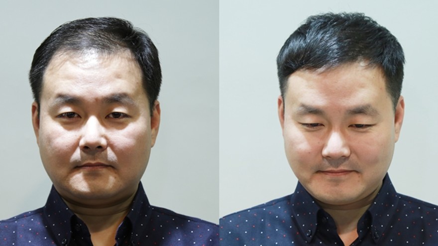헤어증모술 남자 붙임머리 다증모 차이점과 가격 네이버 포스트