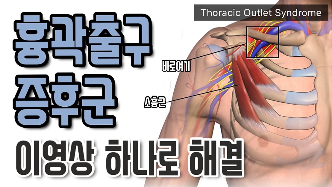 목 디스크 증상과 유사한 흉곽출구증후군목 어깨 통증팔 저림손 저림 네이버 Tv