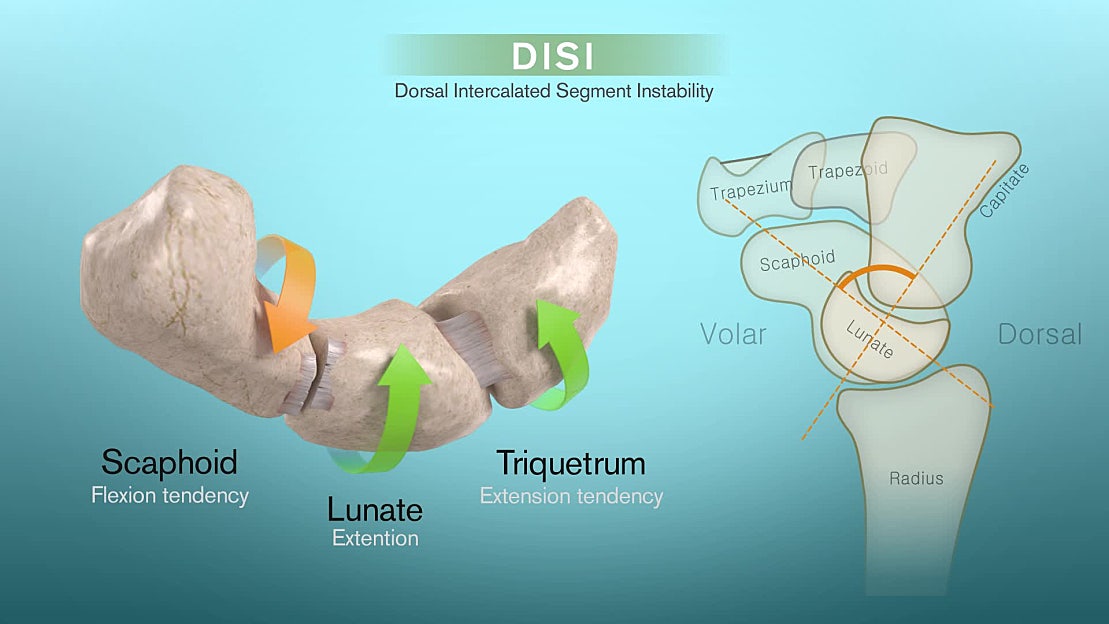Carpal Instability_DISI and VISI deformity_3D 영상 - 네이버 TV