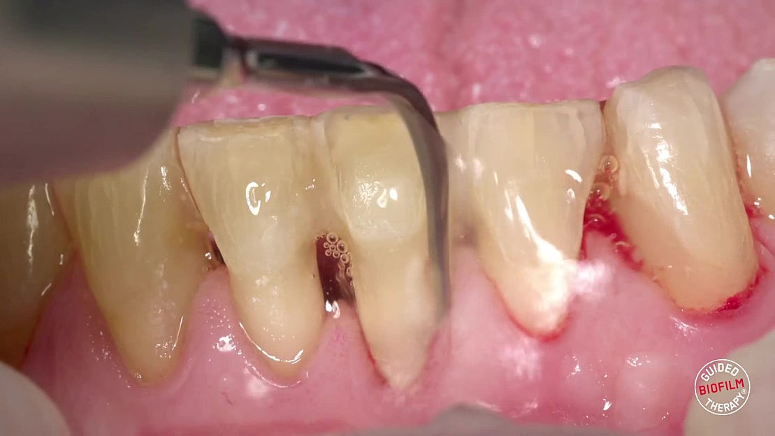 GBT 덴탈케어 케이스 : 과잉치석(heavy calculus) 환자 - 네이버 TV