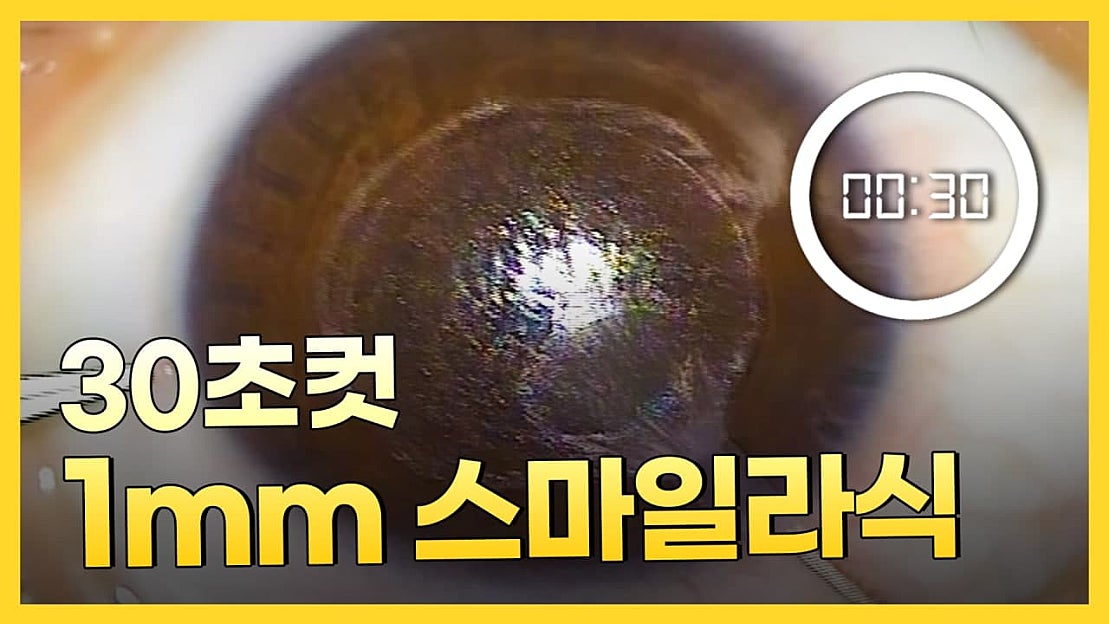 김부기원장님 1mm 스마일라식 수술 영상 - 네이버 TV