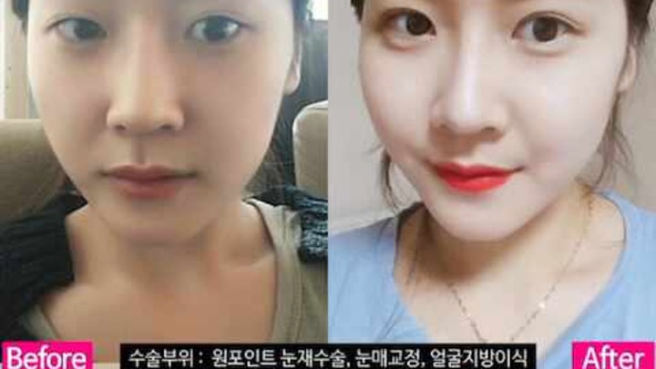 쌍커풀재수술후기 예쁜 곳 ☆ (쌍꺼풀성형후기,돌출눈 쌍수,쌍꺼풀재수술잘하는병원) - NAVER NOW.