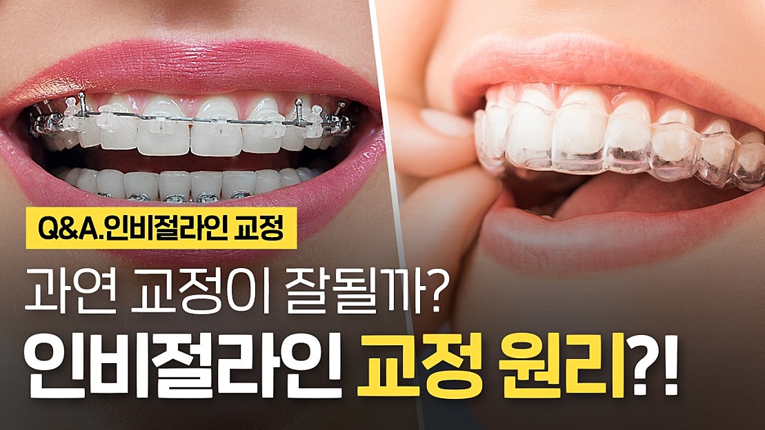 인비절라인 투명교정의 원리는 과연 치아교정이 잘될까feat강남 아름드리치과 네이버 Tv