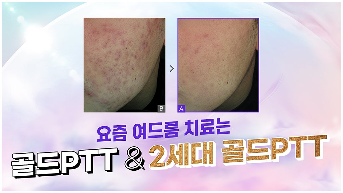 여드름치료 잘하는 피부과는 골드PTT&2세대 골드PTT(GBR PTT)를 합니다. - 네이버 TV