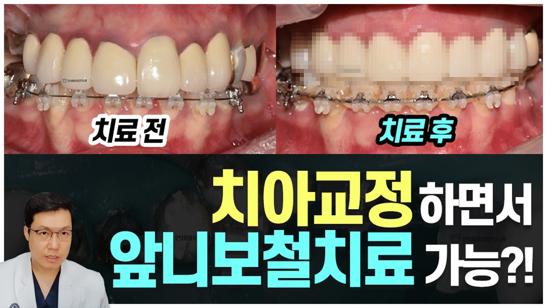 치아교정 중 앞니치료 가능 재신경치료보철치료로 예쁘게 완성 앞니재치료 연세마이덴 네이버 Tv