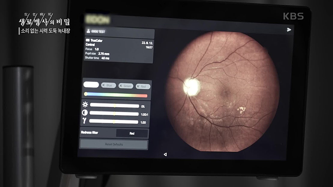 녹내장, 왜 자극 증상을 느끼지 못했을까? | KBS 220831 방송 - 네이버 TV