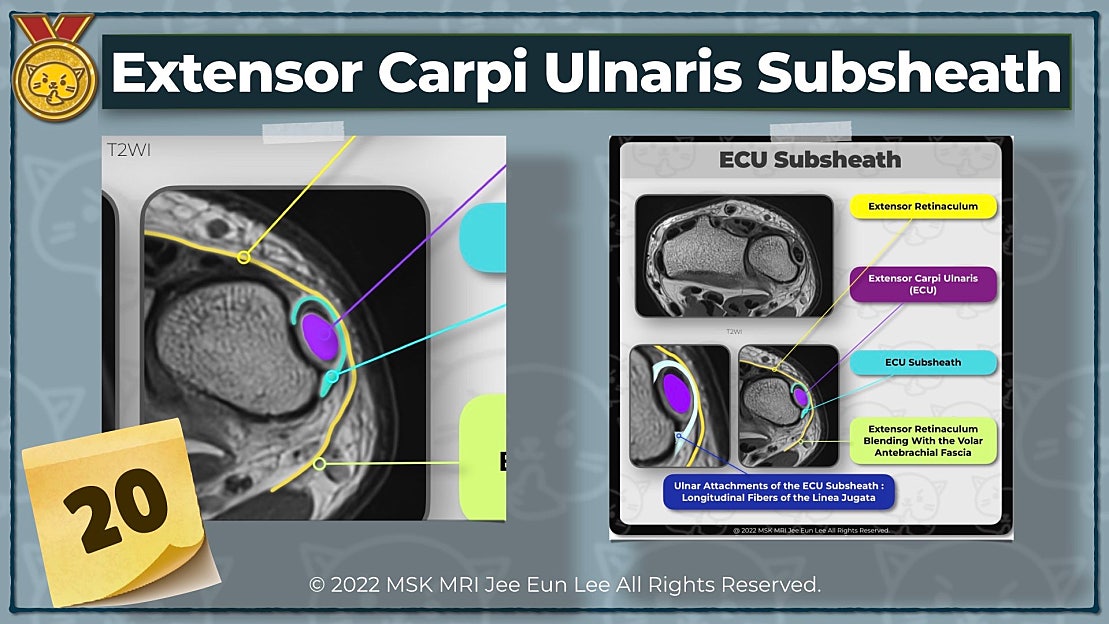[Anatomy_20] Extensor carpi ulnaris (ECU) subsheath complex, Linea ...