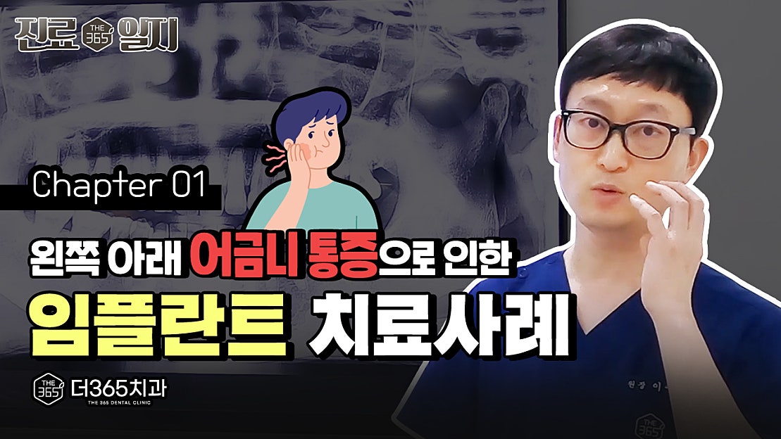 어금니 통증 잇몸염증 발치 후 뼈이식 임플란트 사례 주말진료 더365치과 진료일지 네이버 Tv