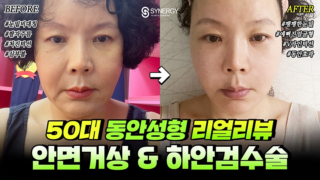 안면거상술 And 하안검수술로 10년은 젊어진 50대 동안성형 찐 후기 Feat 신논현성형외과 네이버 Tv