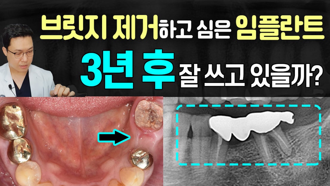왼쪽 아래 어금니가 가만히 있어도 통증이ㅠㅠ오래된 브릿지제거어금니임플란트 3년 후 네이버 Tv