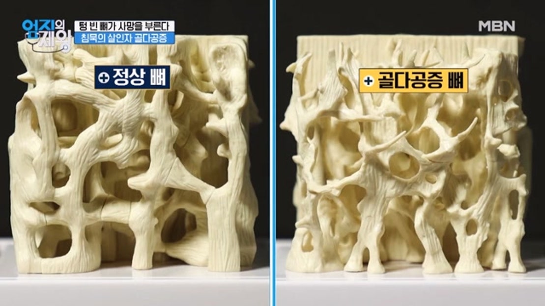 중년 여성 위협하는 골다공증! 골다공증이 사망을 부른다?! MBN 230117 방송 - 네이버 TV