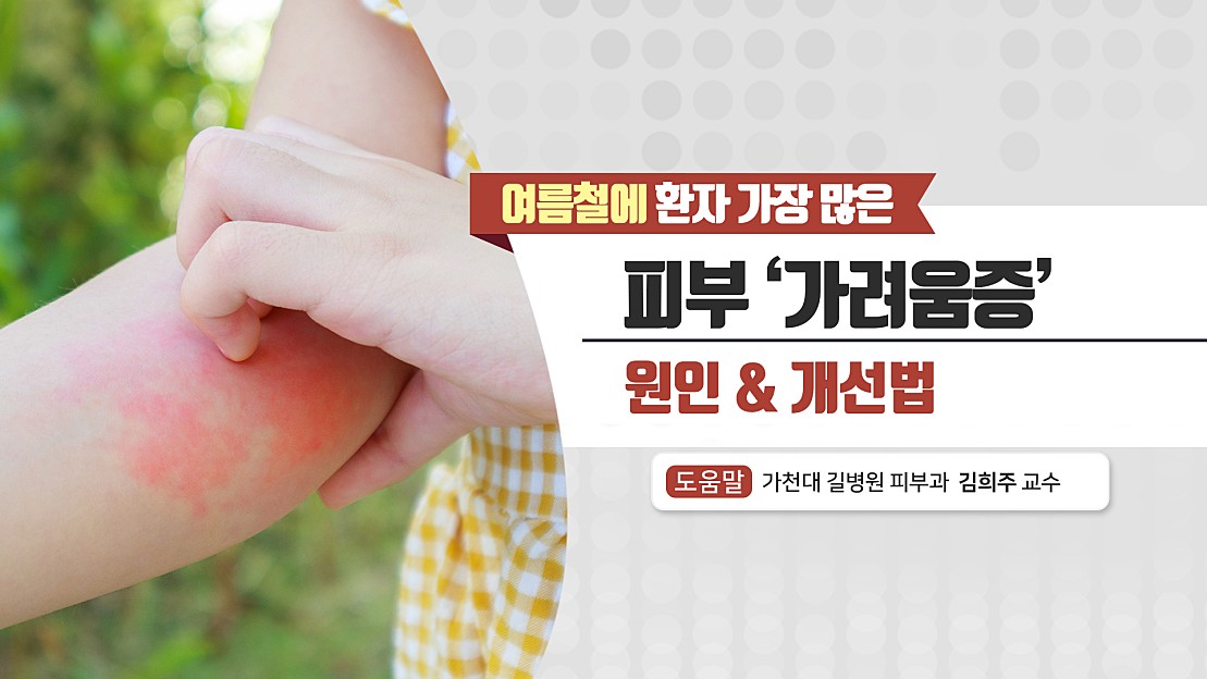 여름철에 환자 가장 많은 피부 ‘가려움증 원인 And 개선법 네이버 Tv