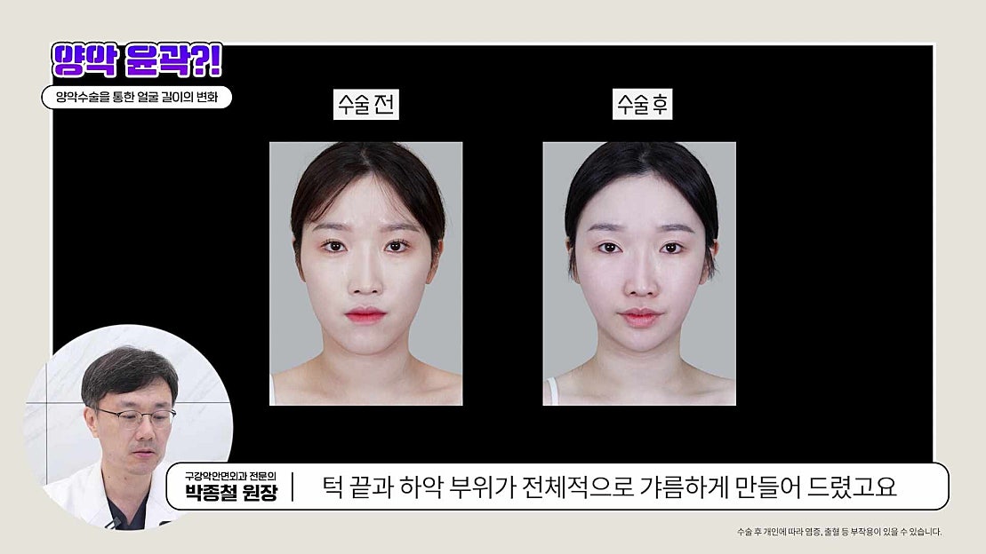 주걱턱 SSRO BSSRO IVRO VRO 양악수술로 얼굴이 작아지는 두가지 원리 - 하악지각도 교합면위치 - 네이버 TV
