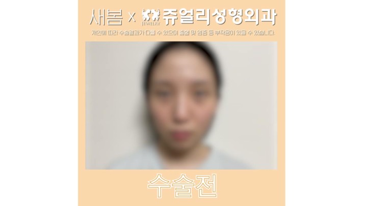 쥬얼리성형외과 성형전후 성형후기 눈성형 코성형 네이버 Tv