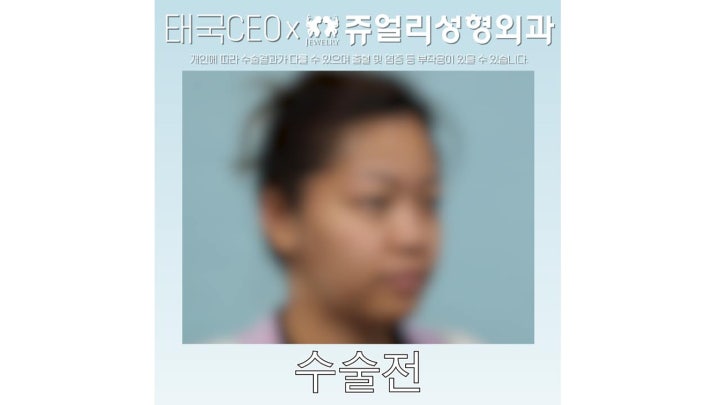 쥬얼리성형외과 성형전후 성형후기 수술전후 네이버 Tv