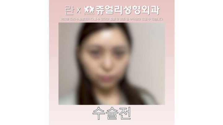 쥬얼리성형외과 성형전후 수술전후 성형후기 리얼후기 네이버 Tv