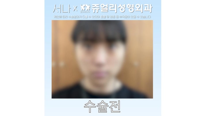 쥬얼리성형외과 성형전후 성형후기 전후영상 리얼후기 네이버 Tv