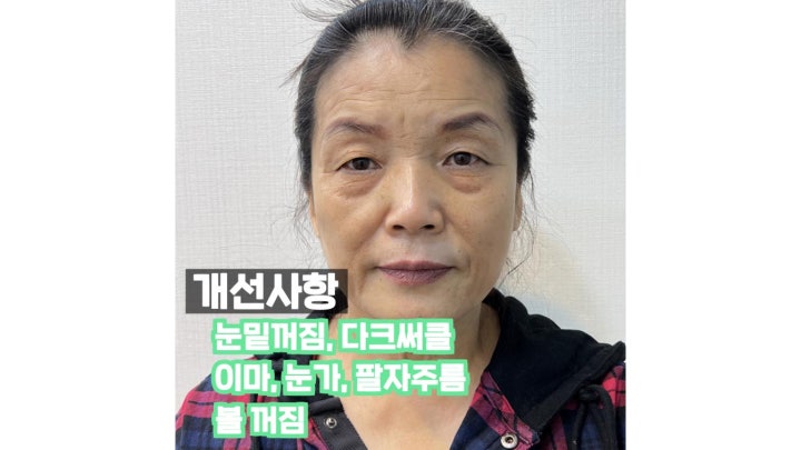 쥬얼리성형외과 성형전후 개선사항 성형후기 중년수술 중년성형 동안 네이버 Tv