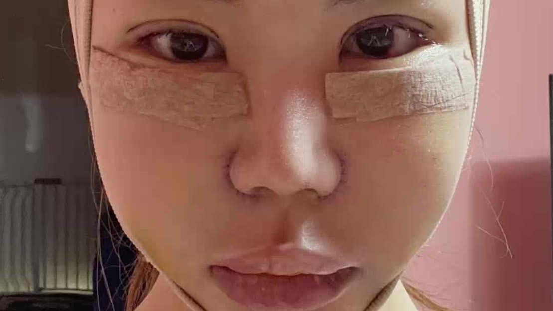 쥬얼리성형외과 성형외과 성형후기 리얼후기 성형모델 성형전후 네이버 Tv